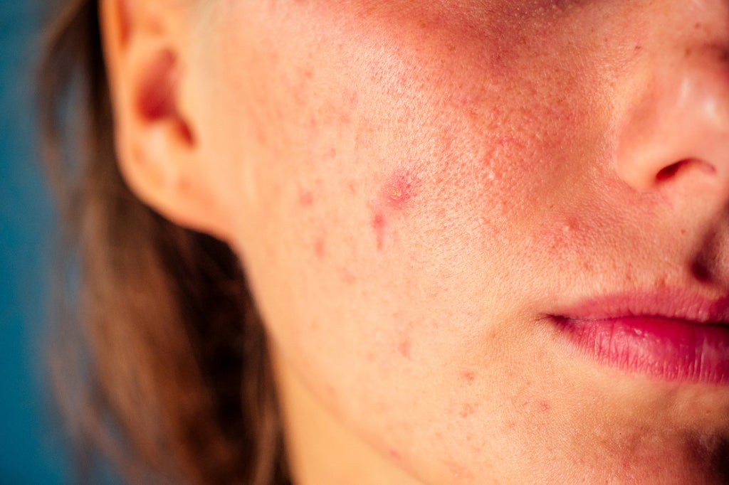 How to Fight Chronic Acne Breakouts – Eva Naturals